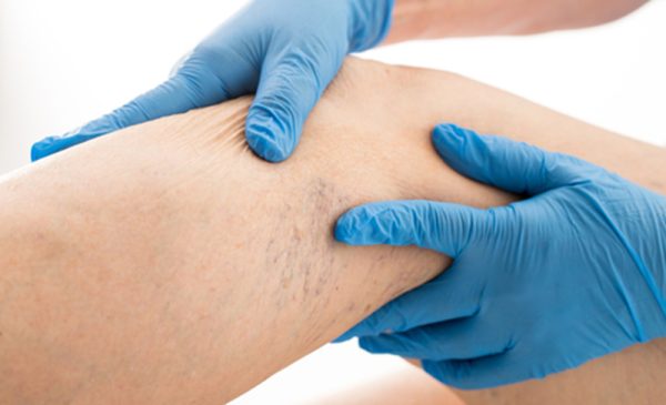 Lower Limb Swelling: Causes and Solutions | My FootDr