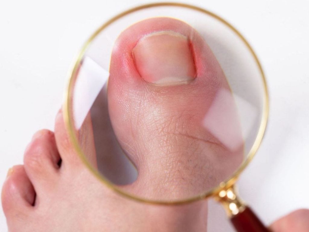 Does Your Big Toenail Keep Hurting My FootDr Singapore does-your-big-toenail-keep-hurting-my-footdr-singapore