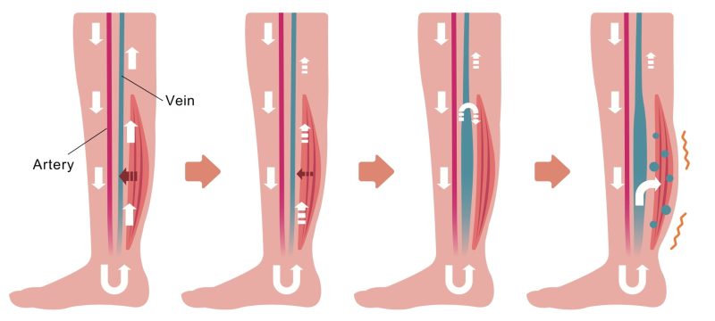 Lower Limb Swelling Causes And Solutions Lower Limb Swelling Causes And Solutions