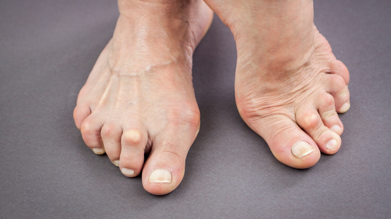 How to Relieve and Prevent Foot and Ankle Arthritis | My FootDr